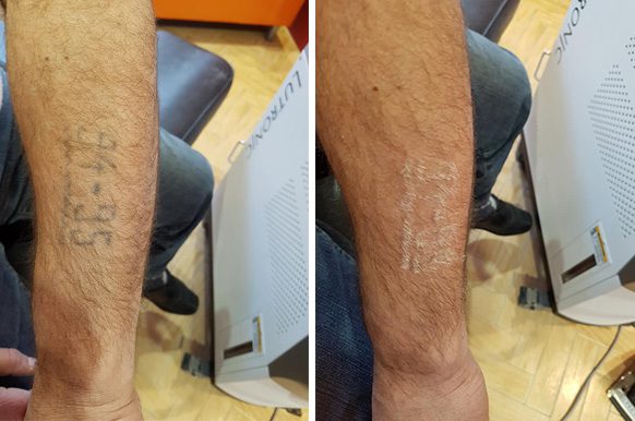 Αφαίρεση τατουάζ | Restart Tattoo Removal Θεσσαλονίκη